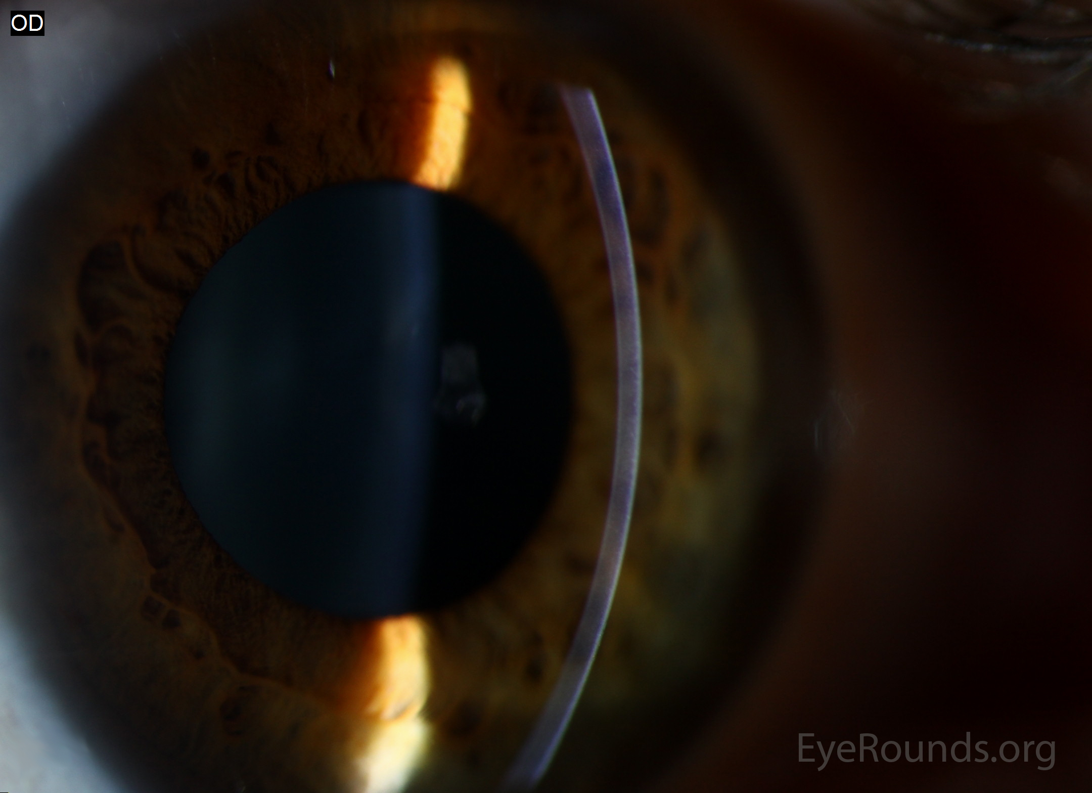 Normal Cornea Normal Cornea