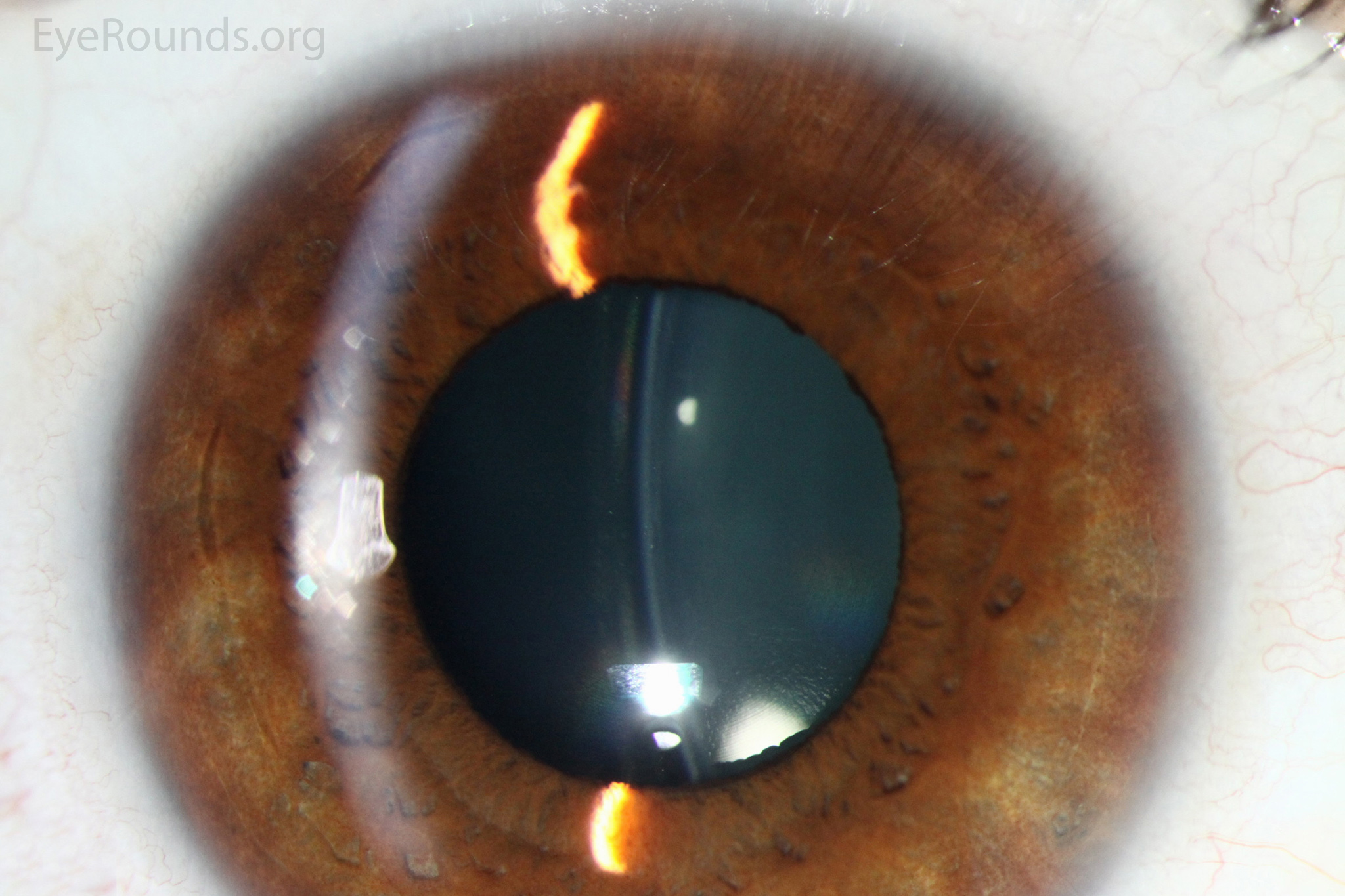 Visian Implantable Collamer Lens ICL Implant