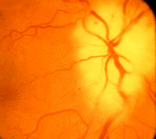 Anterior Ischemic Optic Neuropathy: part 2. A discussion for physicians