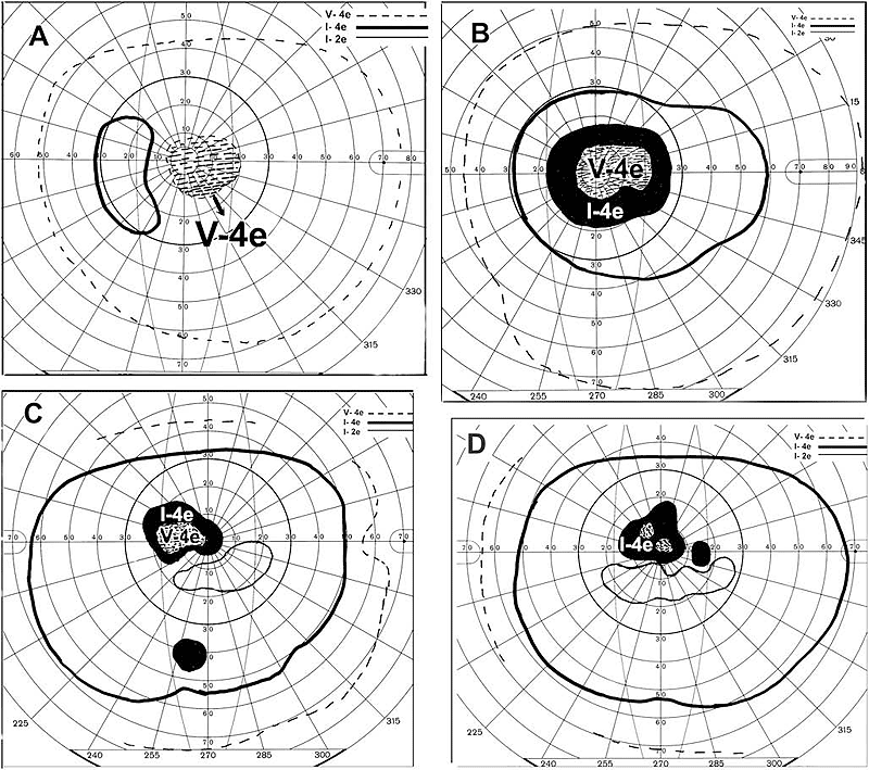 Anterior Ischemic Optic Neuropathy: part 2. A discussion for physicians