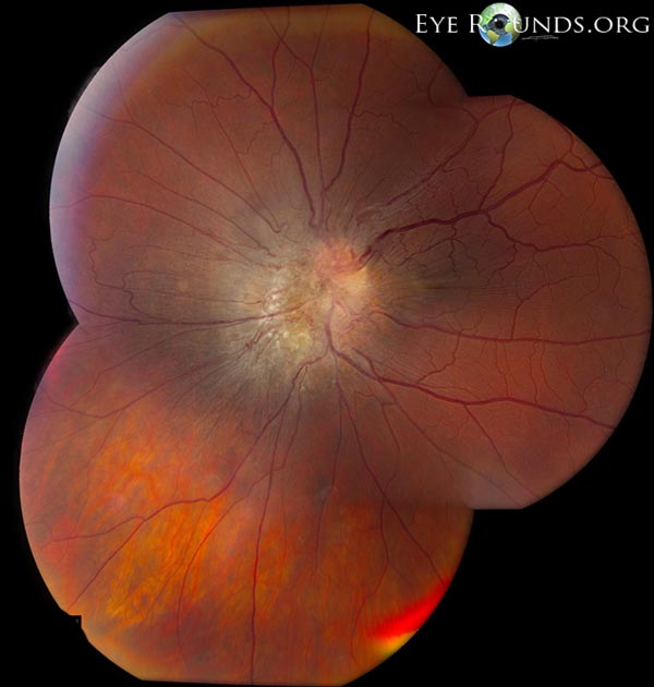 Peripapillary Combined Hamartoma of the Retina and Retinal Pigment ...