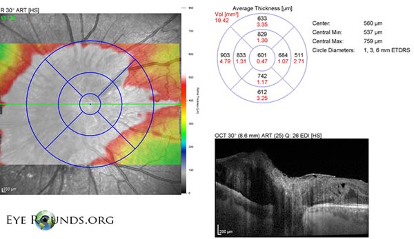 Peripapillary Combined Hamartoma of the Retina and Retinal Pigment ...