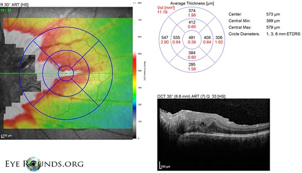 Peripapillary Combined Hamartoma of the Retina and Retinal Pigment ...