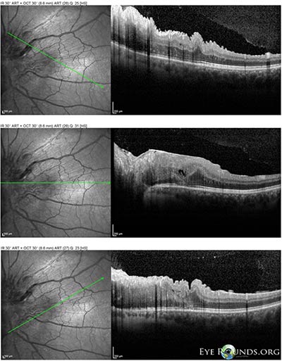 Peripapillary Combined Hamartoma of the Retina and Retinal Pigment ...
