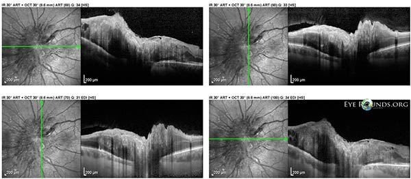 Peripapillary Combined Hamartoma of the Retina and Retinal Pigment ...