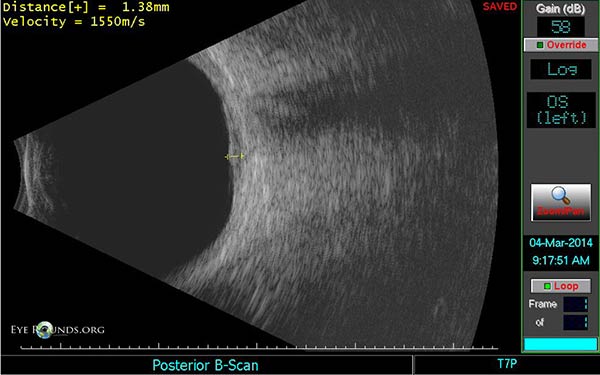 Peripapillary Combined Hamartoma of the Retina and Retinal Pigment ...