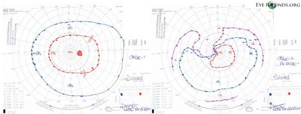 Peripapillary Combined Hamartoma of the Retina and Retinal Pigment ...