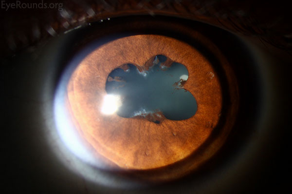 Central posterior synechiae (CPS) in the setting of tubulointerstitial ...