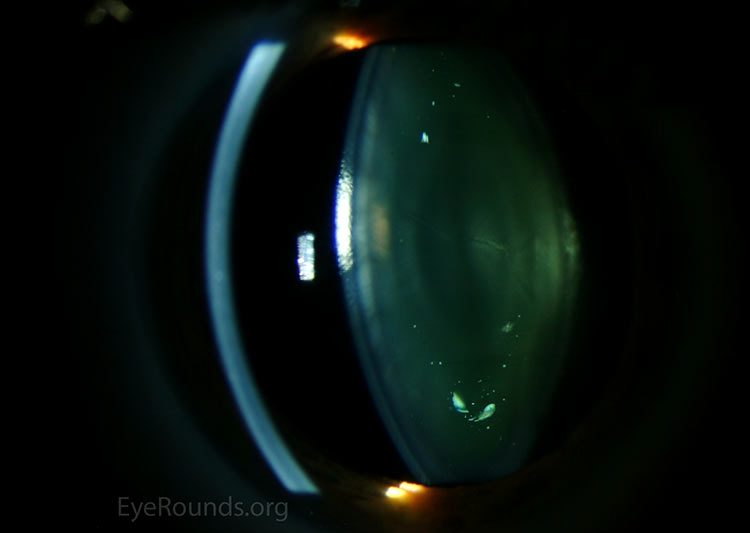 Cerulean Cataract