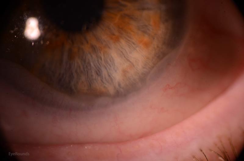 Conjunctival Prolapse under scleral contact lens