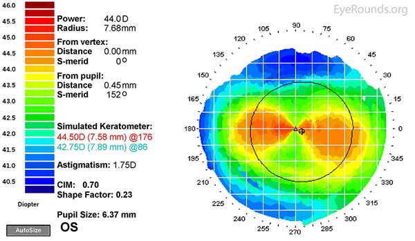 Against-the-rule corneal astigmatism