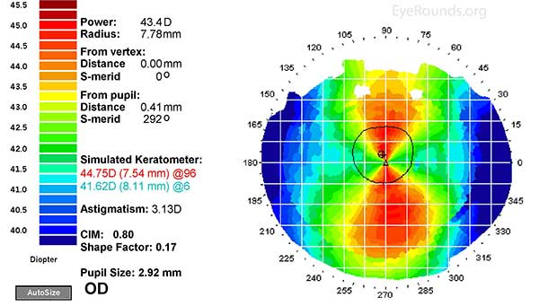 With-the-rule corneal astigmatism