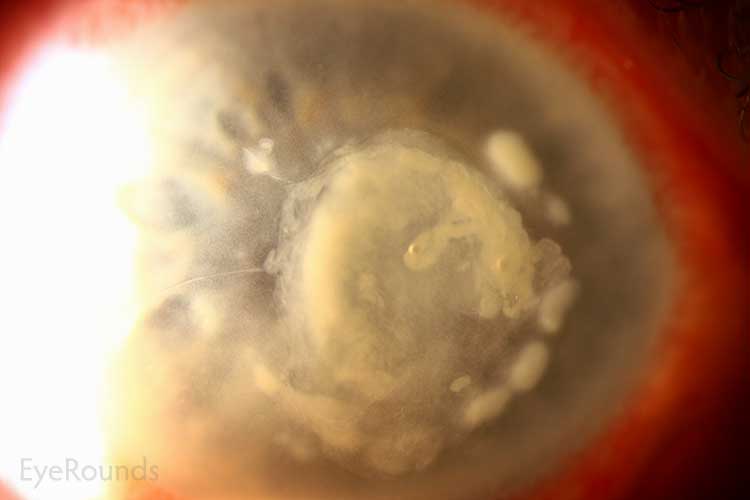 Corneal Satellite Infiltrates: Online Atlas of Ophthalmology: The ...