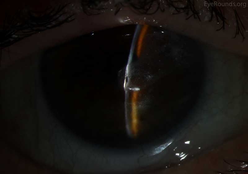Cyanoacrylate Glue Corneal Ulcers at Timothy Bottom blog