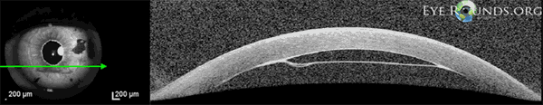 Graft edge lift after Descemet's membrane endothelial keratoplasty (DMEK)