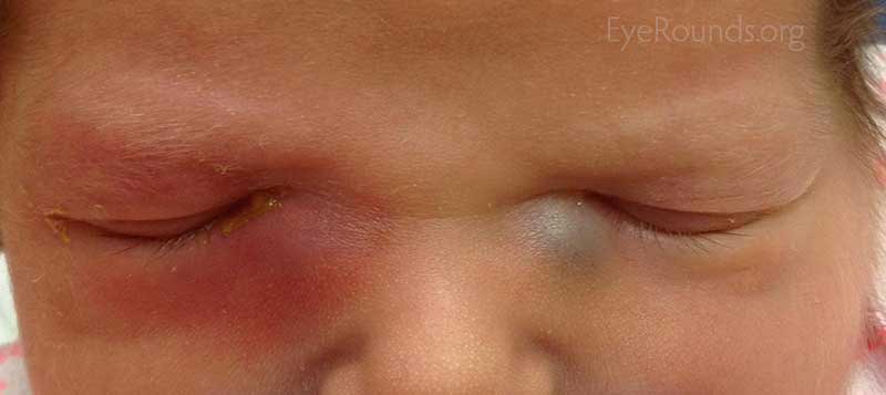 Bilateral Dacryocystoceles with Acute Dacryocystitis