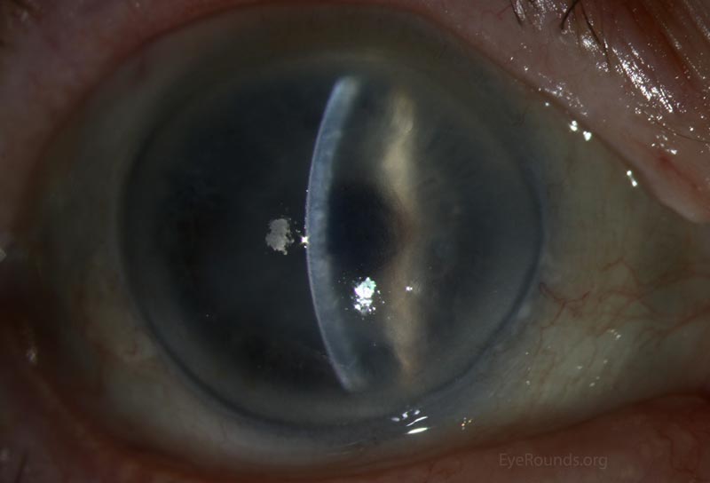 Descemet membrane detachment after cataract extraction