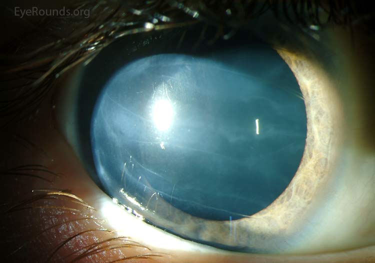 Haab striae in primary congenital glaucoma