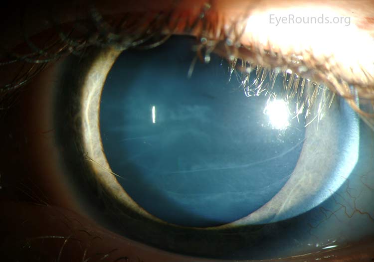 Haab striae in primary congenital glaucoma