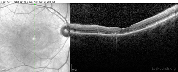 Bull s eye Maculopathy Due To Hydroxychloroquine Toxicity Bull s eye Maculopathy Due To Hydroxychloroquine Toxicity