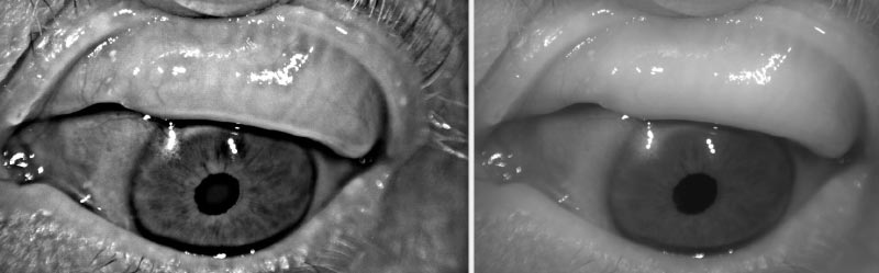 Meibomian Gland Disease . EyeRounds.org: Online Ophthalmic Atlas