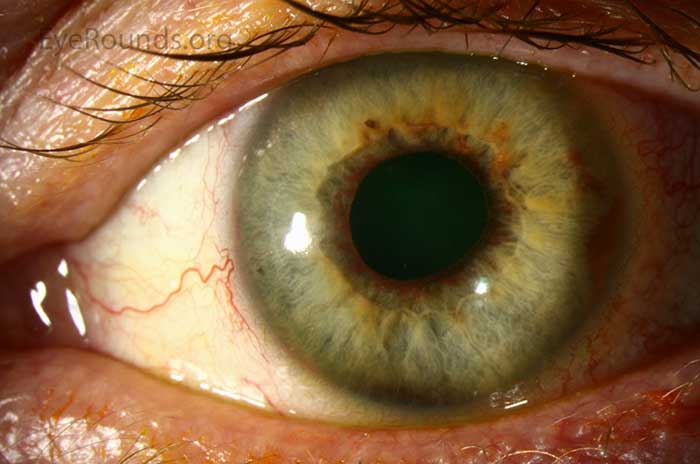 Rubeosis iridis or neovascularization of the iris in diabetes