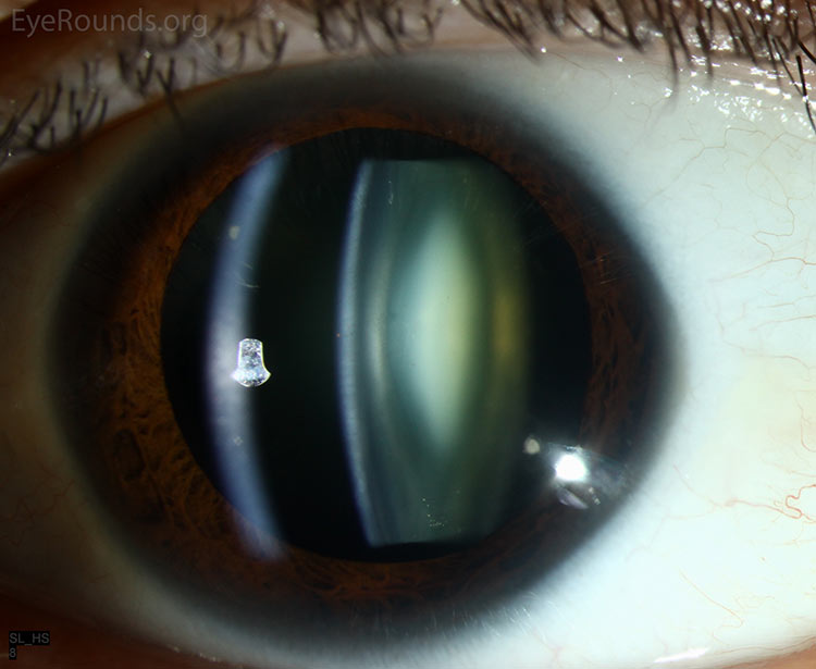 Nuclear sclerotic cataract