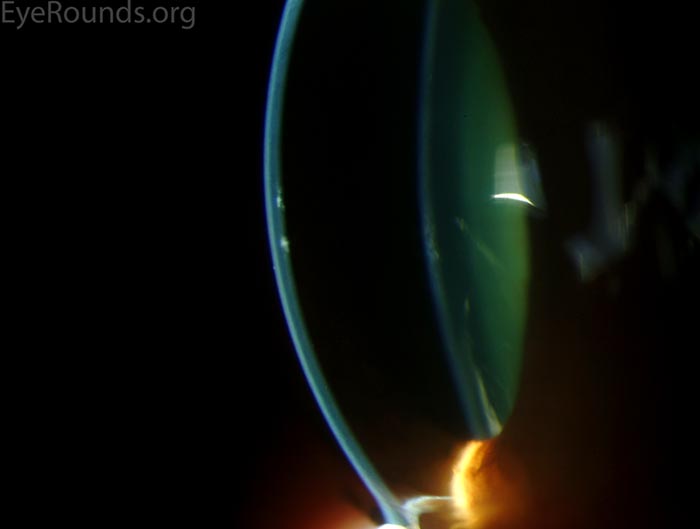 Posterior Polymorphous Corneal Dystrophy (PPMD)