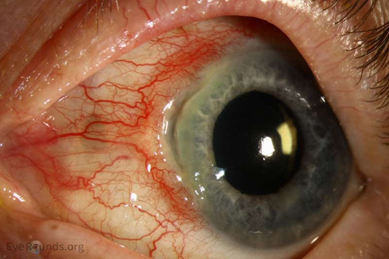 Peripheral ulcerative keratitis (PUK)