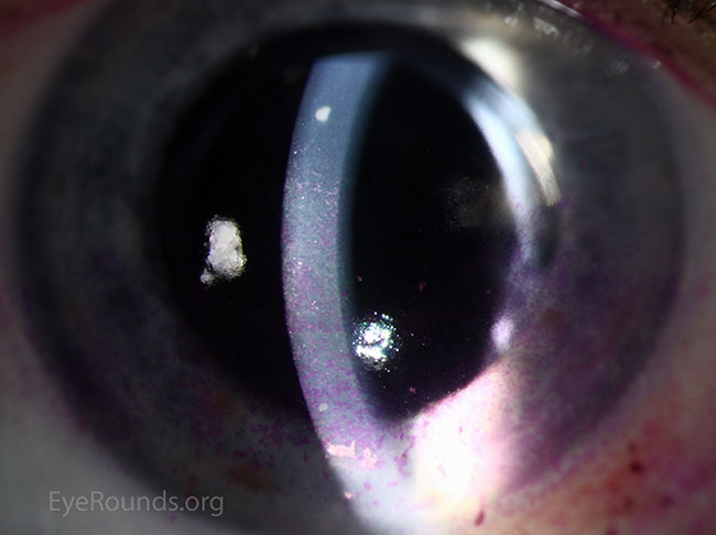 Punctate epithelial erosions (PEE) in exposure keratopathy