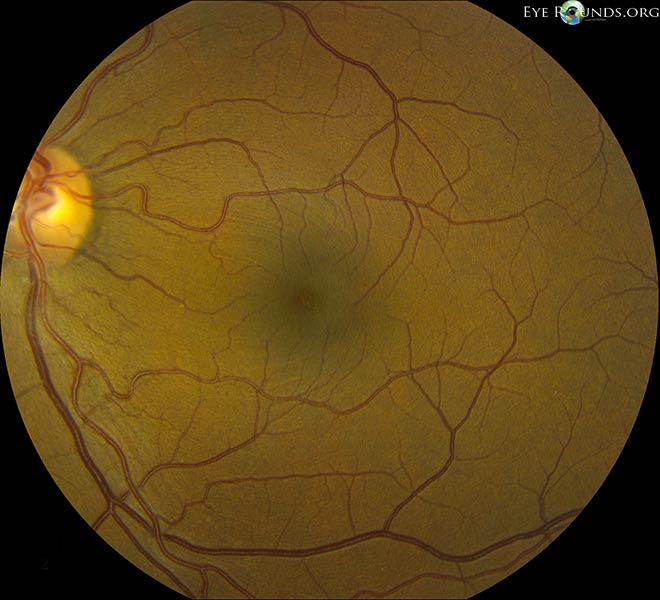 Normal retinal nerve fiber layer and maculopapillary bundle