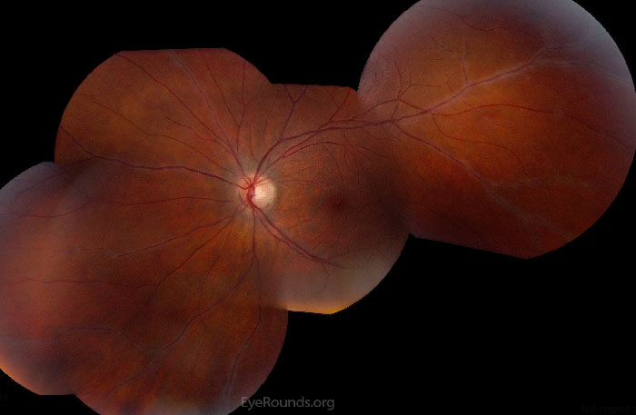 Retinal Periphlebitis