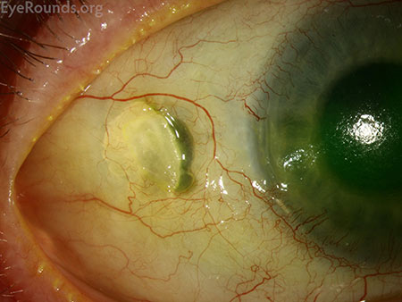 Scleromalacia in the Setting of Rheumatoid Arthritis