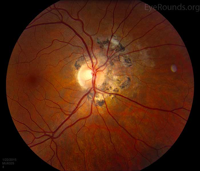 Serpiginous choroidopathy