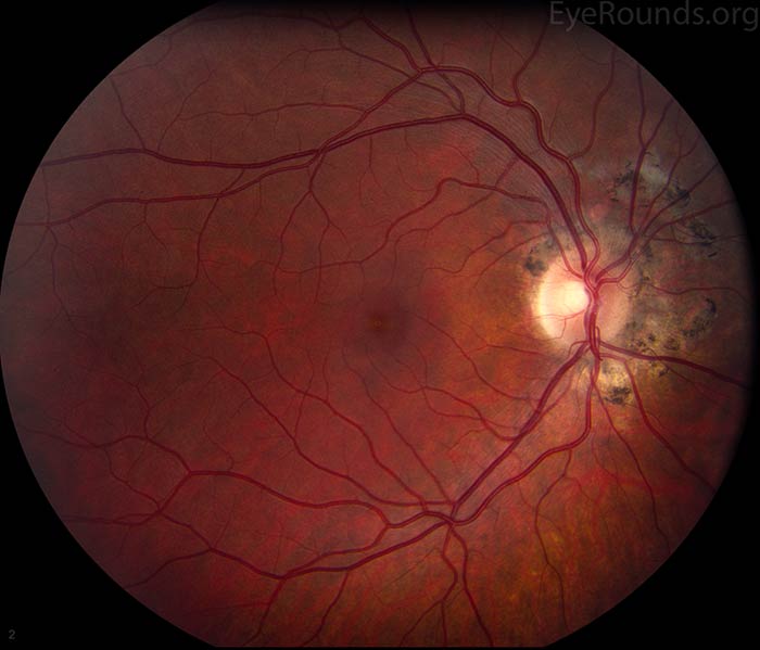 Serpiginous choroidopathy