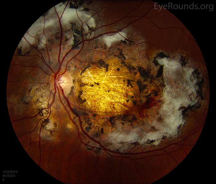 Serpiginous choroidopathy