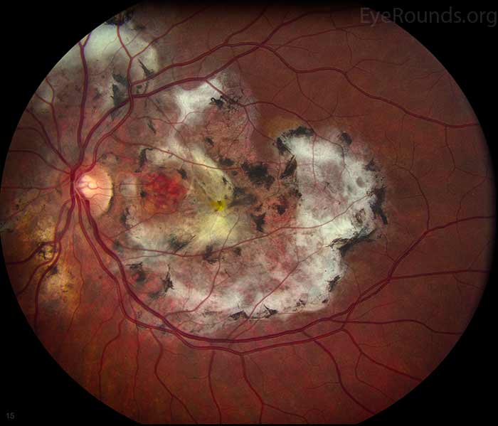 Serpiginous choroidopathy
