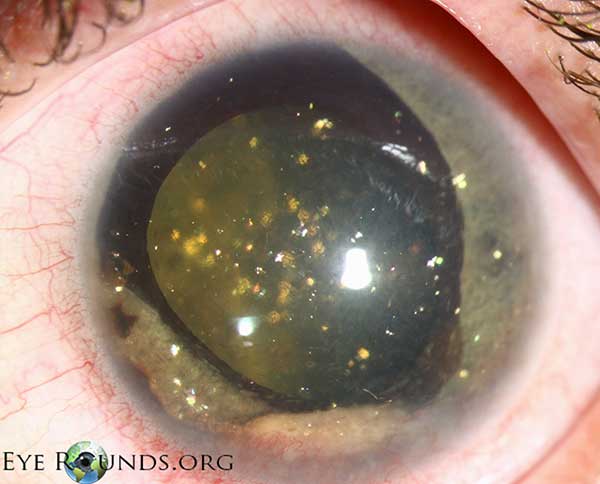 Synchysis Scintillans and a Crystal Pseudohypopyon
