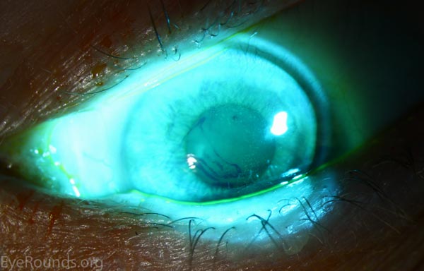 Tear breakup time (TBUT)