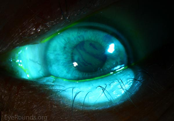 Tear breakup time (TBUT)