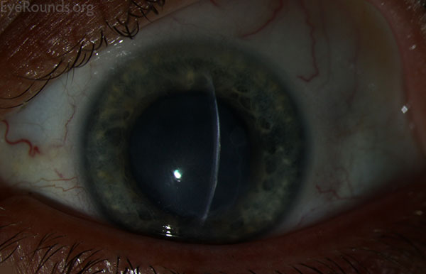 Varicella-zoster virus (VZV) disciform keratitis