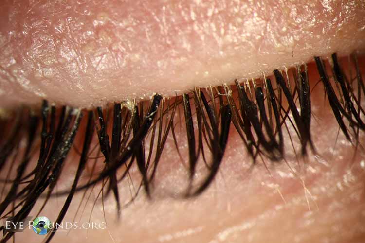 Contact dermatitis secondary to artificial eyelashes: Online Atlas of ...