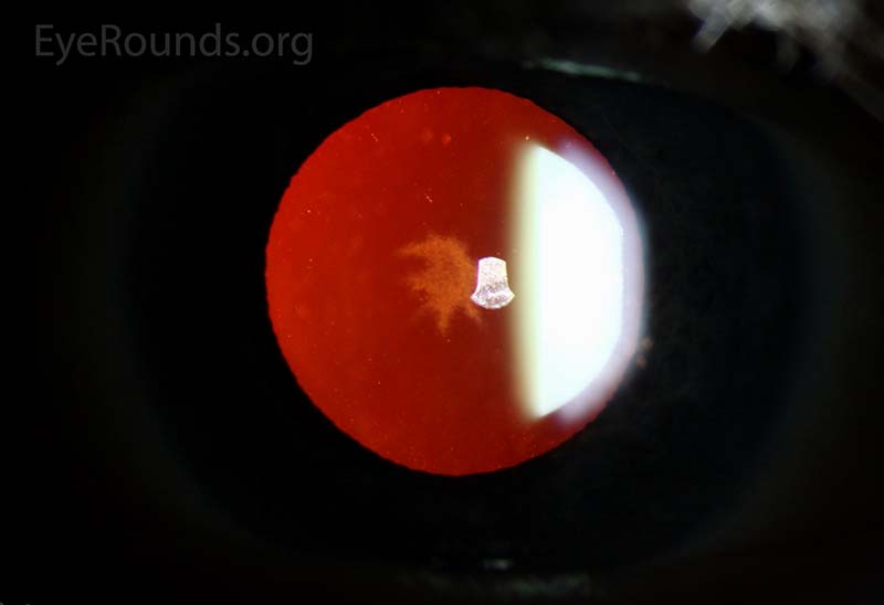 Chlorpromazine-induced cataract