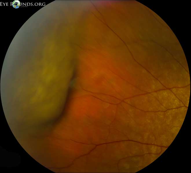 Choroidal Detachment: Hemorrhagic, Non-Appositional