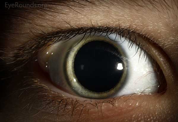 Complex choristoma of the conjunctiva