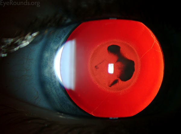 Congenital nuclear cataract