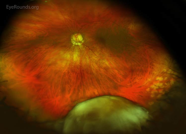 Dislocated crystalline lens