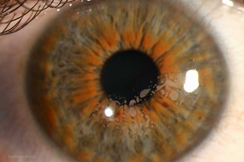 Epithelial ingrowth under LASIK flap
