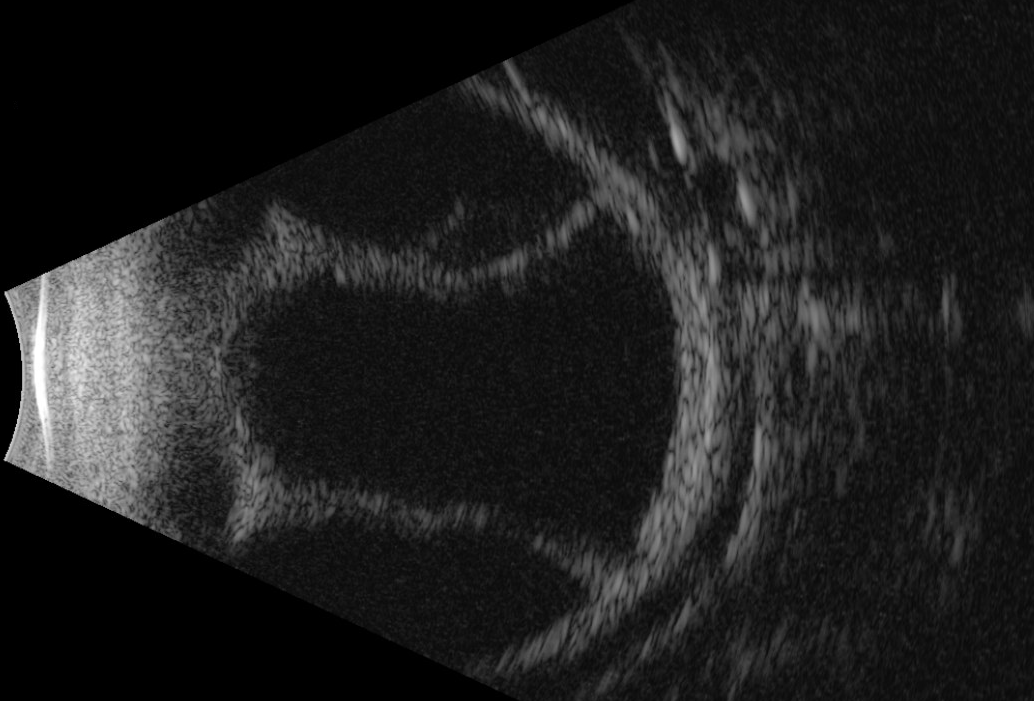 Atlas Entry - Choroidal effusion in posterior scleritis