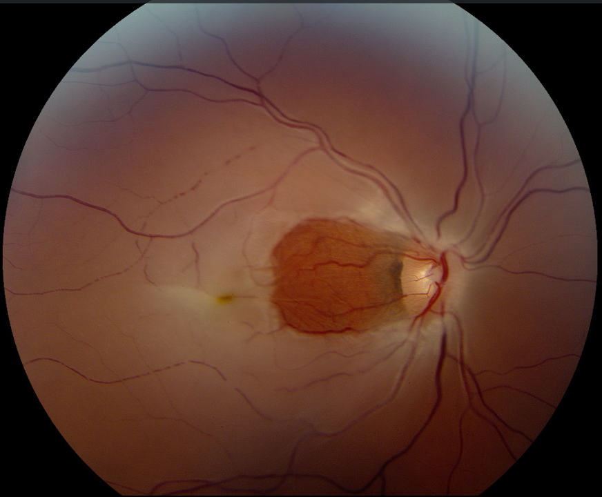 Atlas Entry - Central Retinal Artery Occlusion (CRAO)